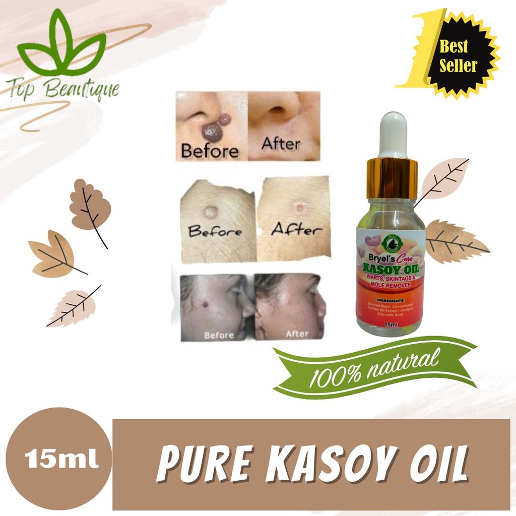 TOPBEAUTIQUE ORGANIC KASOY OIL EFFECTIVE WARTS/KULUGO REMOVER | Shopee ...