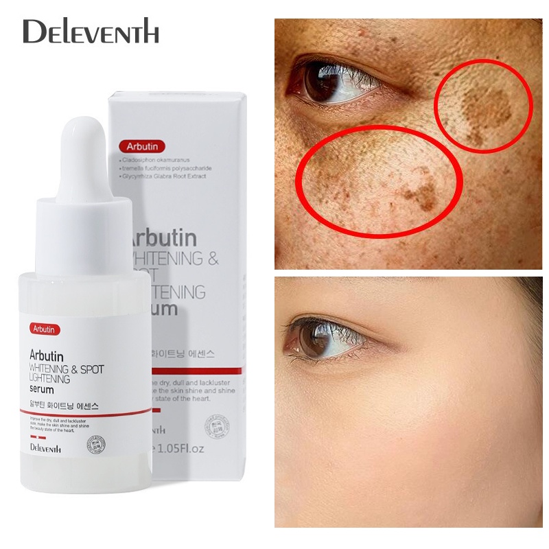 Arbutin Whitening Freckle Face Serum Remove Melasma Essence Fade Dark Spots Melanin Brighten ...