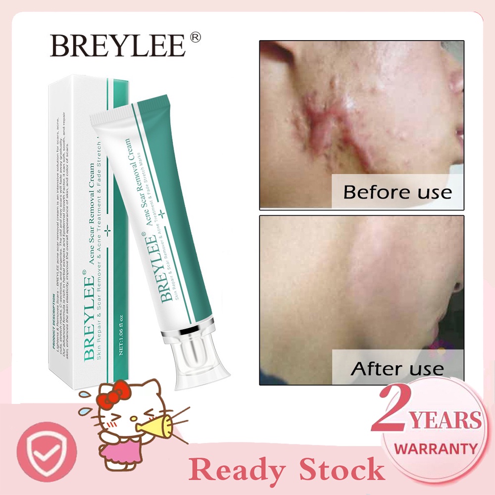 BREYLEE Acne Scar Removal Cream Skin Repair Scar Remover Acne Treatment Fade Stretch Marks Skin ...