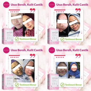 KITSUI Whitie Snow (Probiotic + Pencerahan Kulit) 17's x 15g | Shopee ...