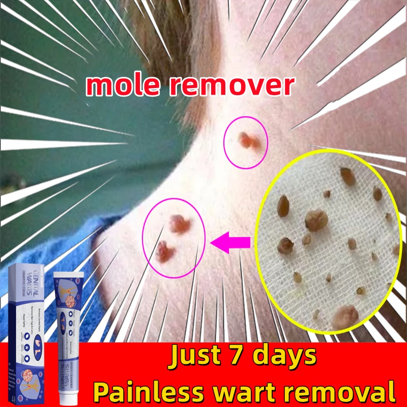 ubat buang tahi lalat ubat buang kutil buang tahi lalat remover mole ...