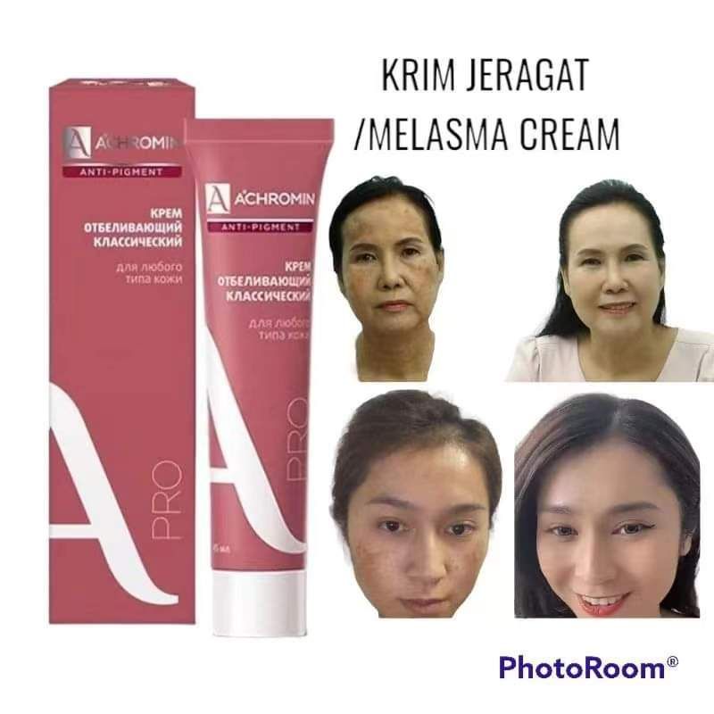 Russian Achromin Melasma Cream - Erase Pigmentation, Age Spots ...