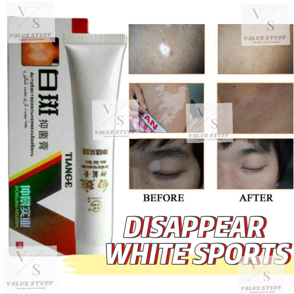 Vitiligo cream Krim White Spot Chinese Medical Pigment Panau Bintik ...