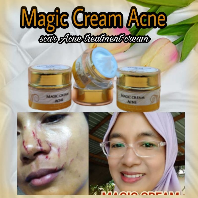 krim parut kudis magic cream ance (scar treatment) | Shopee Malaysia