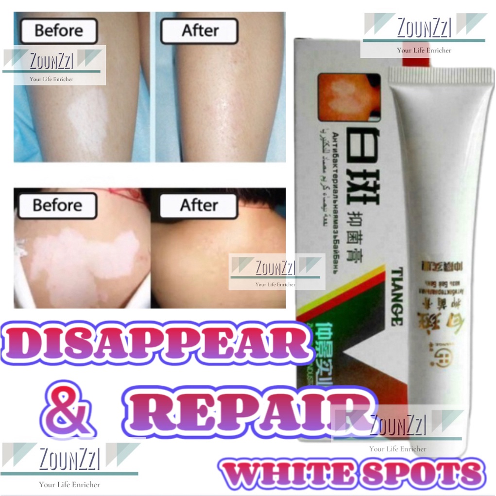 Natural Anti Vitiligo Whitening Skincare Dark Spot Pigmentation Cream ...