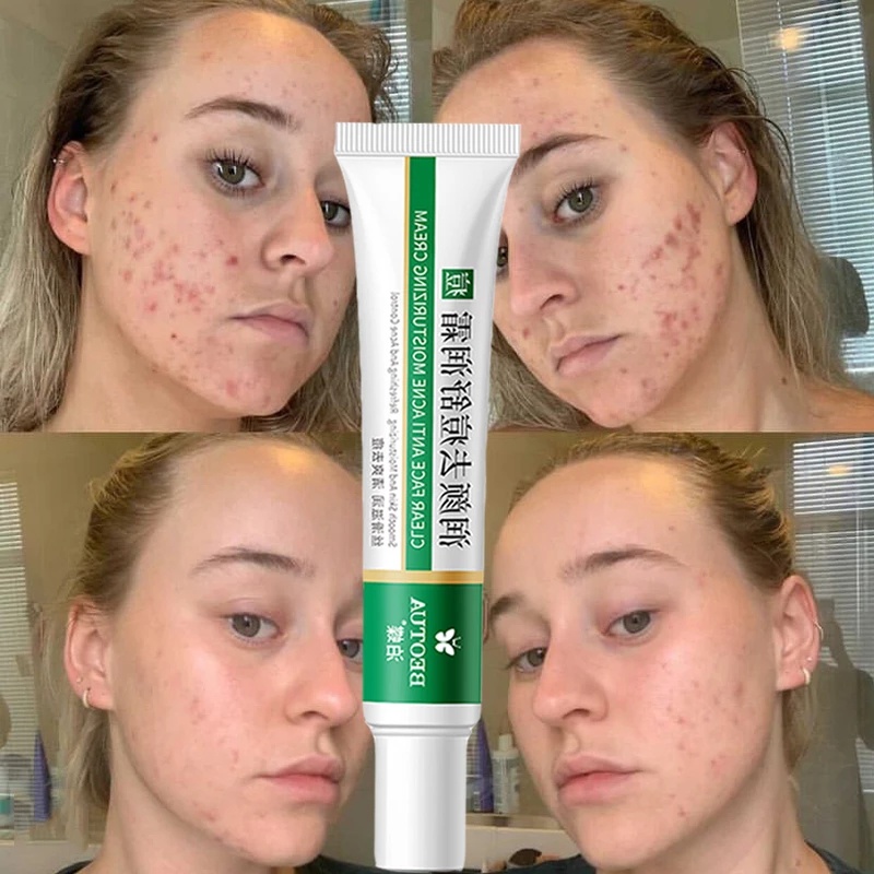 Effective Acne Removal Cream Aloe Acne Spots Control Anti-aging Moisturizing Whitening Acne ...