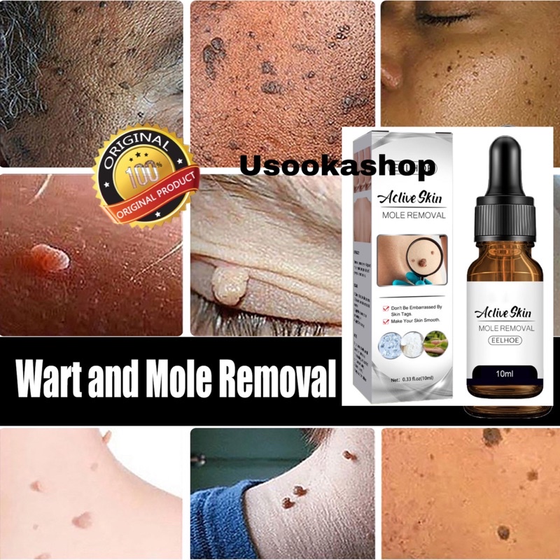 Ubat ketuat buang kutil dan biji kolesterol Mole removal Skin tag wart ...