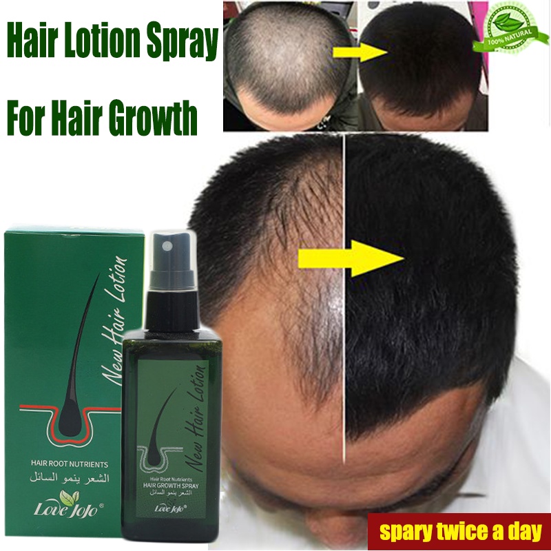 Hair growth spray Neo Hair Lotion Spray ubat rambut botak hair loss ...