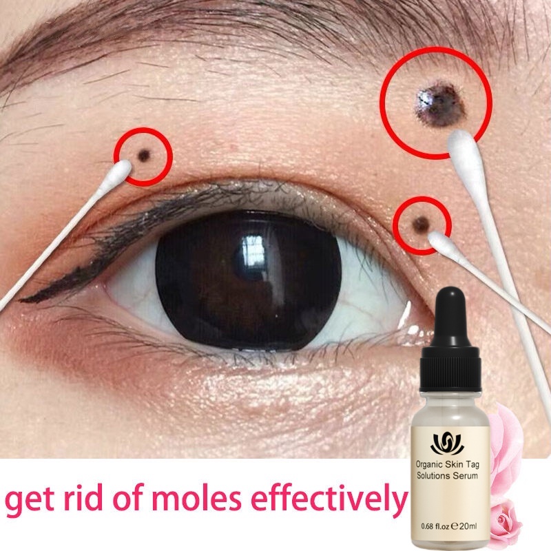 buang tahi lalat mole remover serum 20ml tahi lalat remover skin tag ...