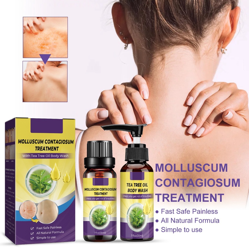 Molluscum Contagiosum Treatment Kit Solution & Tea Tree Oil Body Wash | Shopee Malaysia