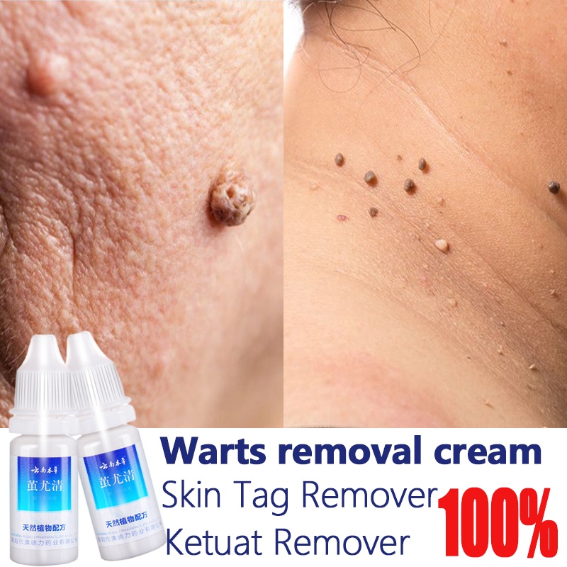 Wart Remover skin tag remover Liquid Meat Thorns Corns Ointment callus ...