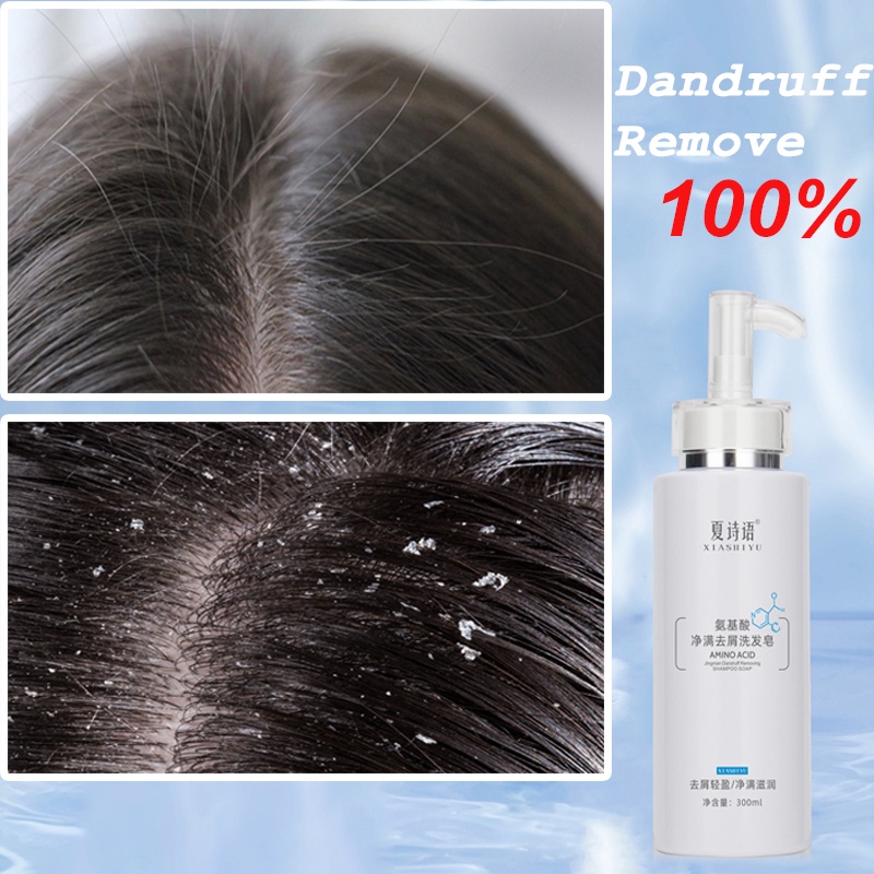 Shampoo Kelemumur Anti Dandruff Shampoo Dandruff Treatment Ubat Kulit