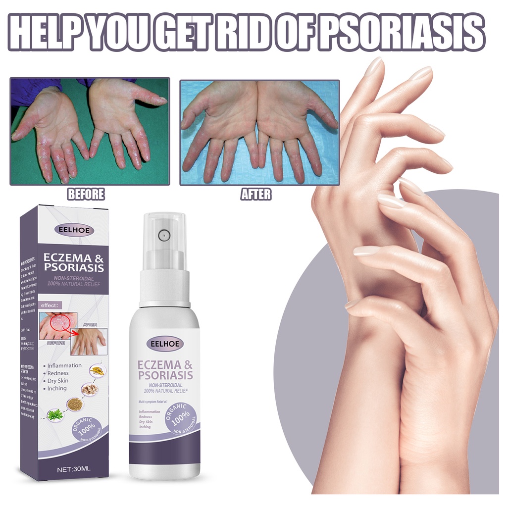 2023 New Tinea Pedis Spray Eczema Ointment Scalp Psoriasis Hand Tinea ...