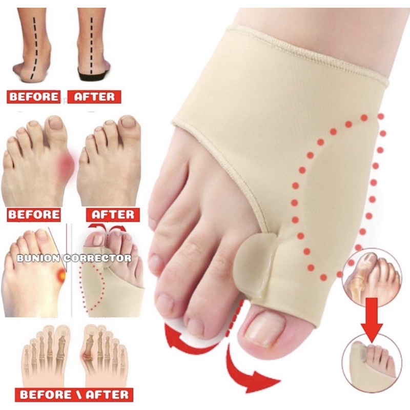 Bunion Corrector Big Toe Splint Straightener Correction Hallux Valgus ...