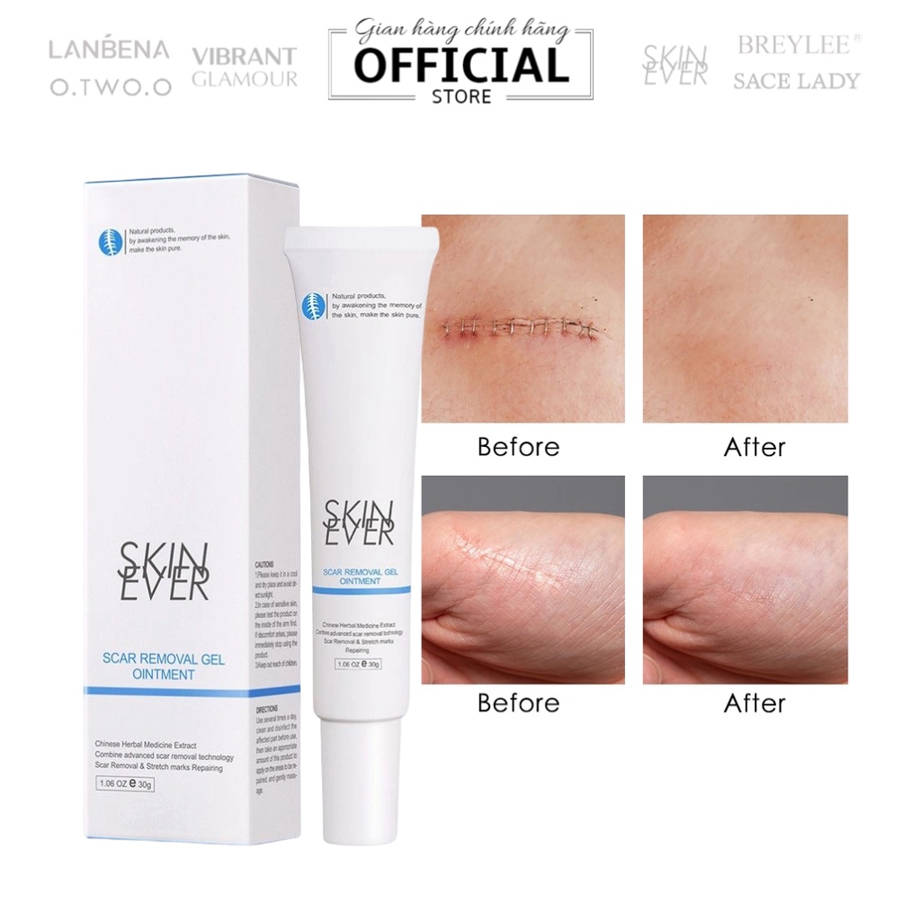 Skin Ever Scar Removal Gel Ointment | Shopee Malaysia