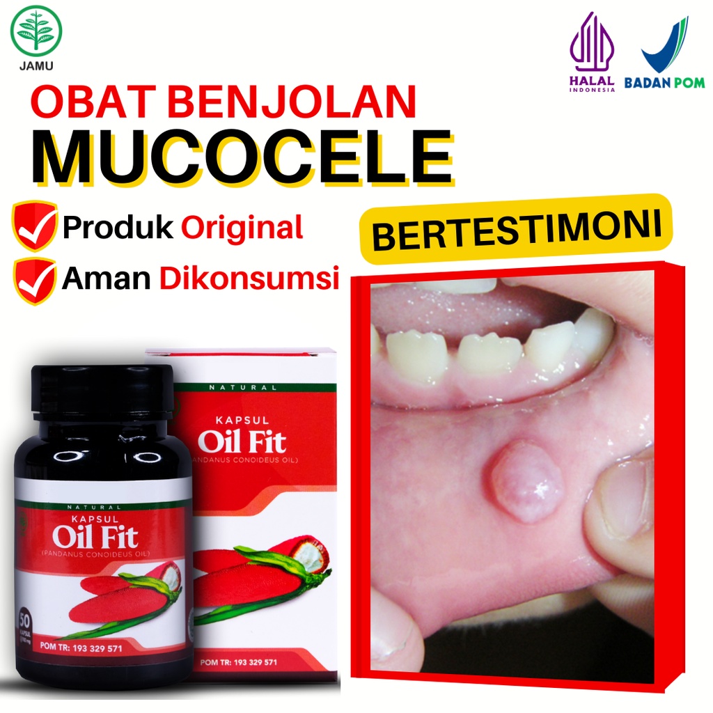 MERAH Mucocele Medicine Lips to Destroy Lumps Under the Tongue Mucocele ...