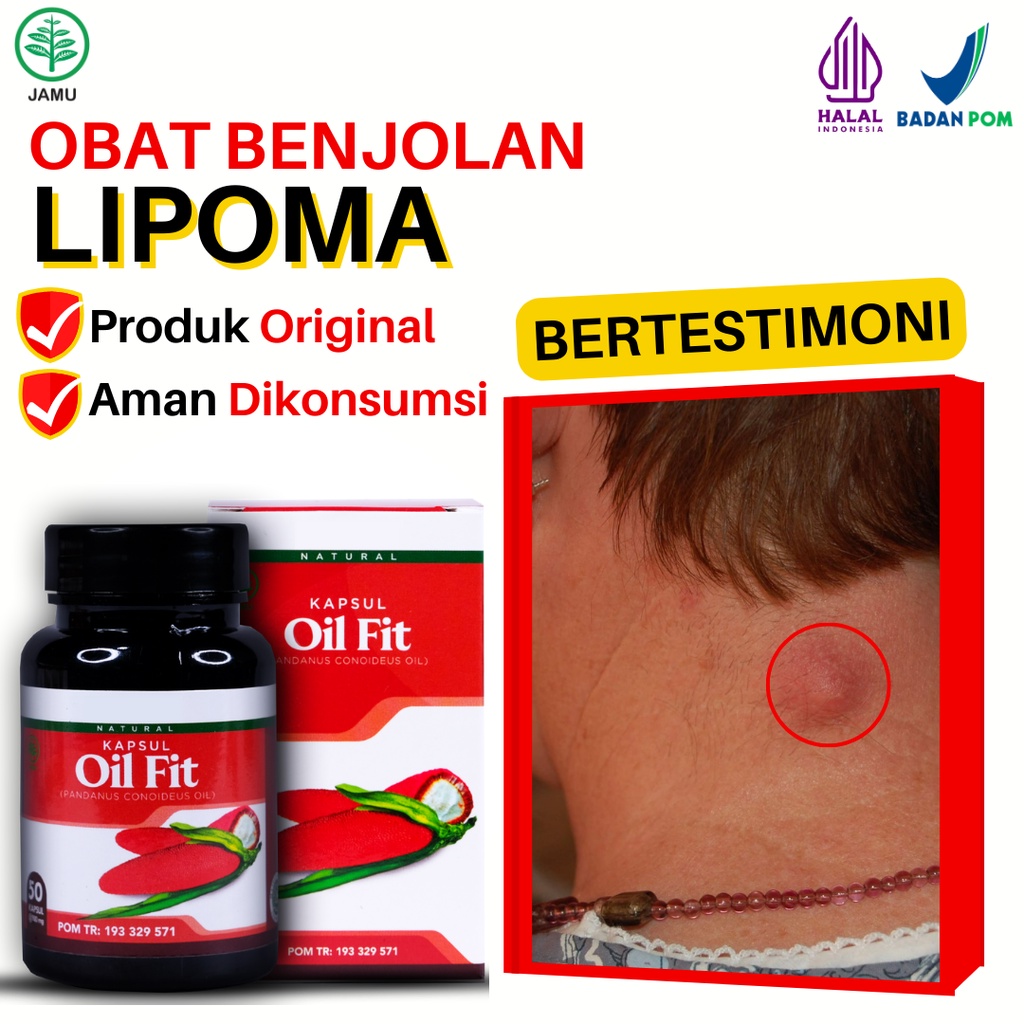 Lipoma Destruction Medicine Deflating Lumps on the Neck Swollen Lymph ...
