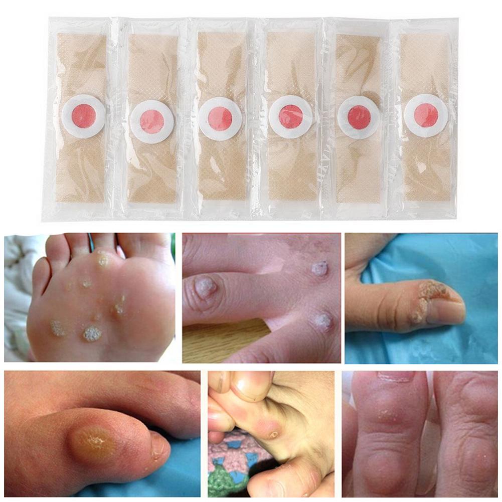 Chicken Eye Patch To Remove Hard Calluses Warts Hand And Foot Calluses ...