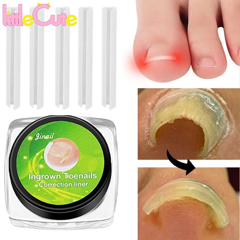 10Pcs Professional Ingrown Toenail Correction Tool / Ingrown Toenail ...