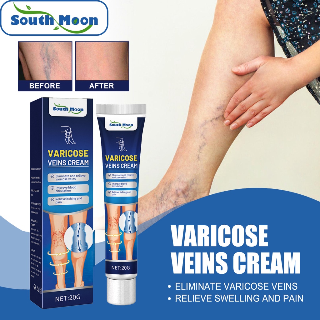 South Moon Varicose Veins Cream Vasculitis Phlebitis Spider Pain Relief ...