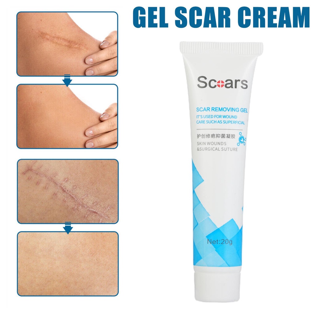 20g Scar Cream Scar Removal Cream Peklat Remover Acne Marks Acne ...