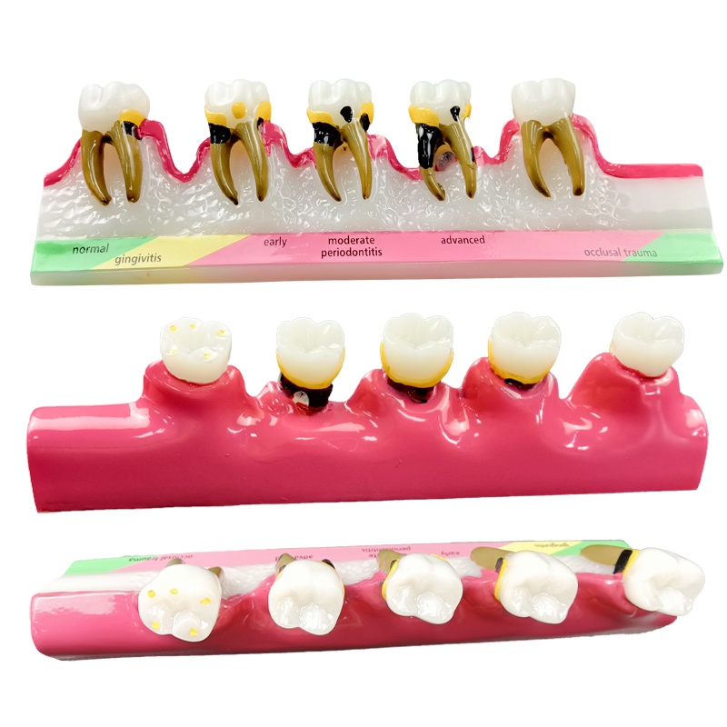Tooth Model Dental Model Periodontal Disease Assort Demo Teeth Model ...