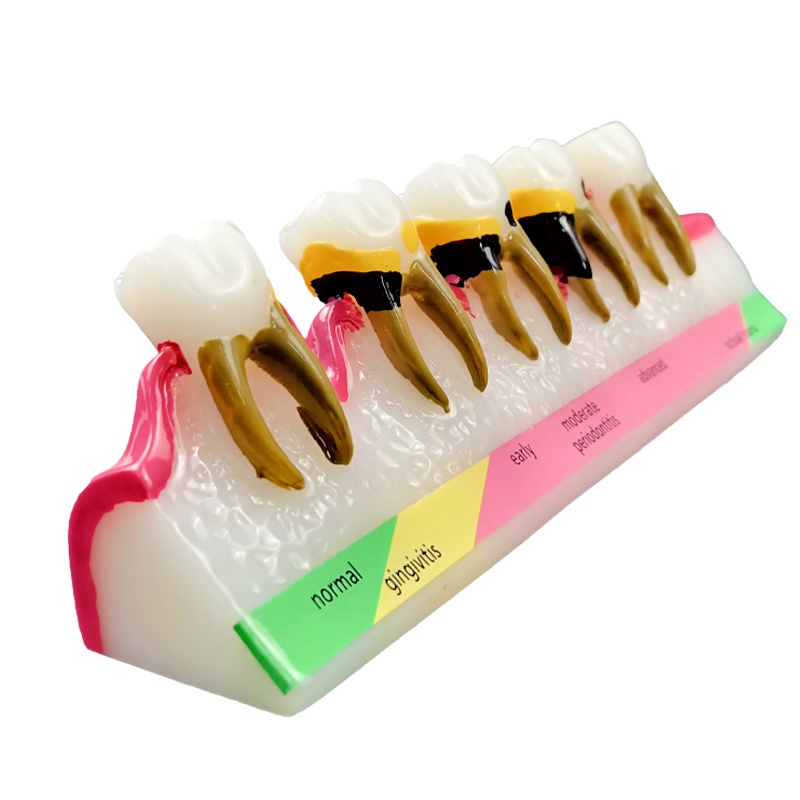 Tooth Model Dental Model Periodontal Disease Assort Demo Teeth Model ...