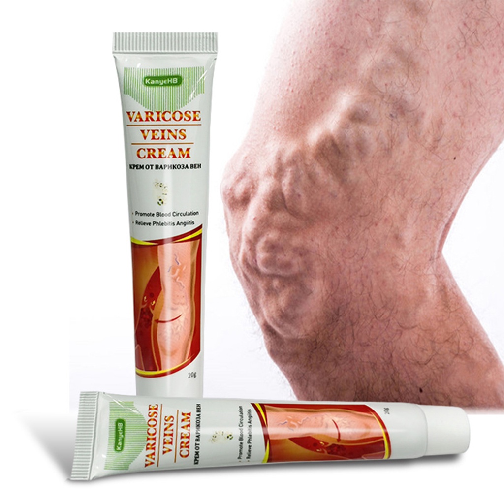 [OOR] 20g Veins Cream Quick Effect Relieve Itching Natural Varicose ...
