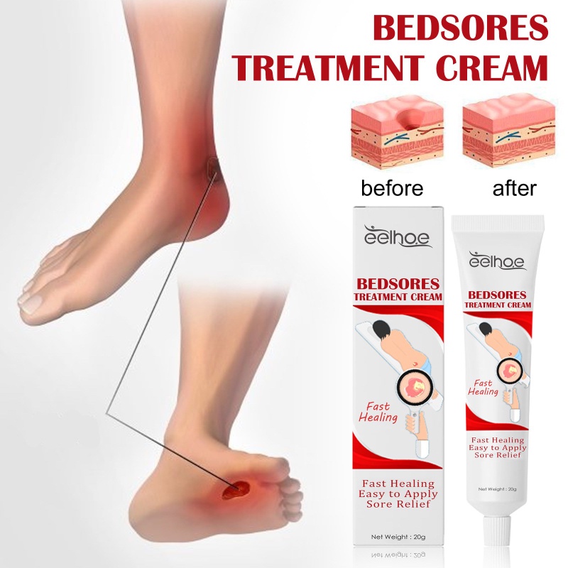 Bedsores Wound Healing Cream Inhibit Fungal Sores Treatment Pain ...