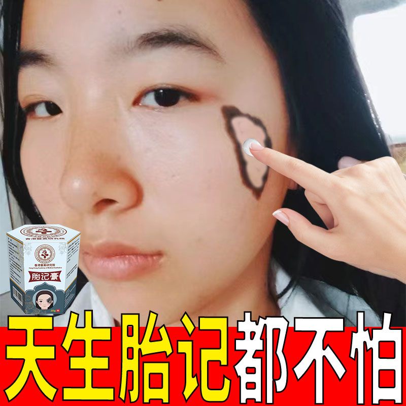 Hot Sale #[ Quick Remove Birthmark] Freckle Removal Birthmark Birthmark ...