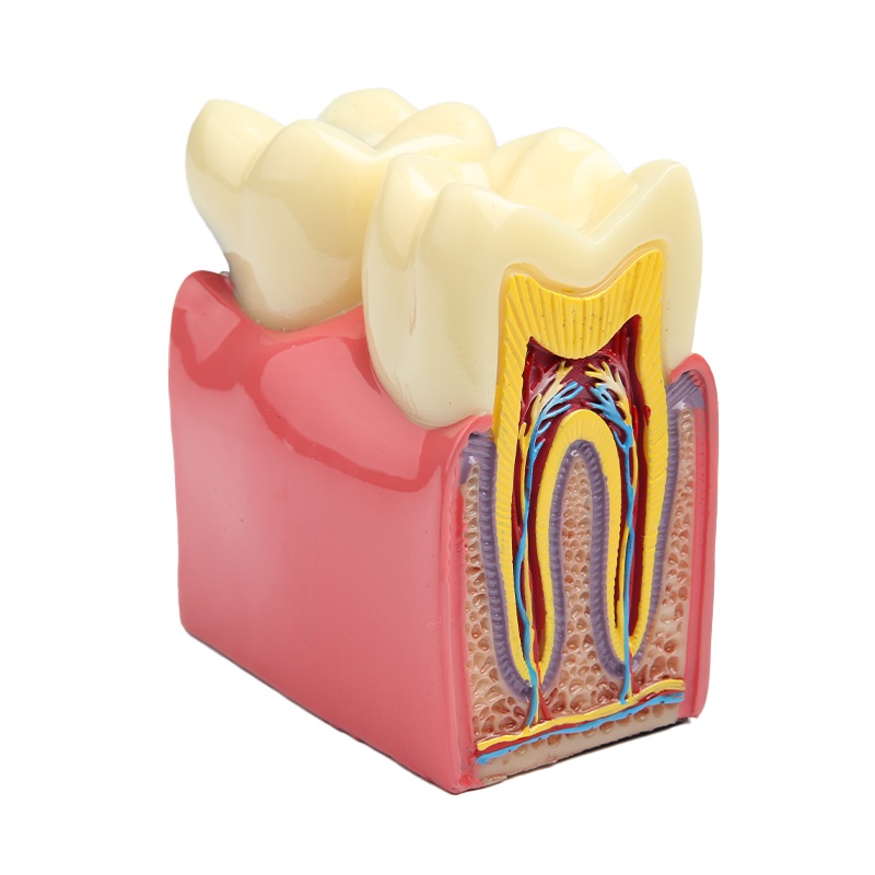 1Pcs 6 Times Dental Caries Comparsion Models Tooth Decay Model For ...