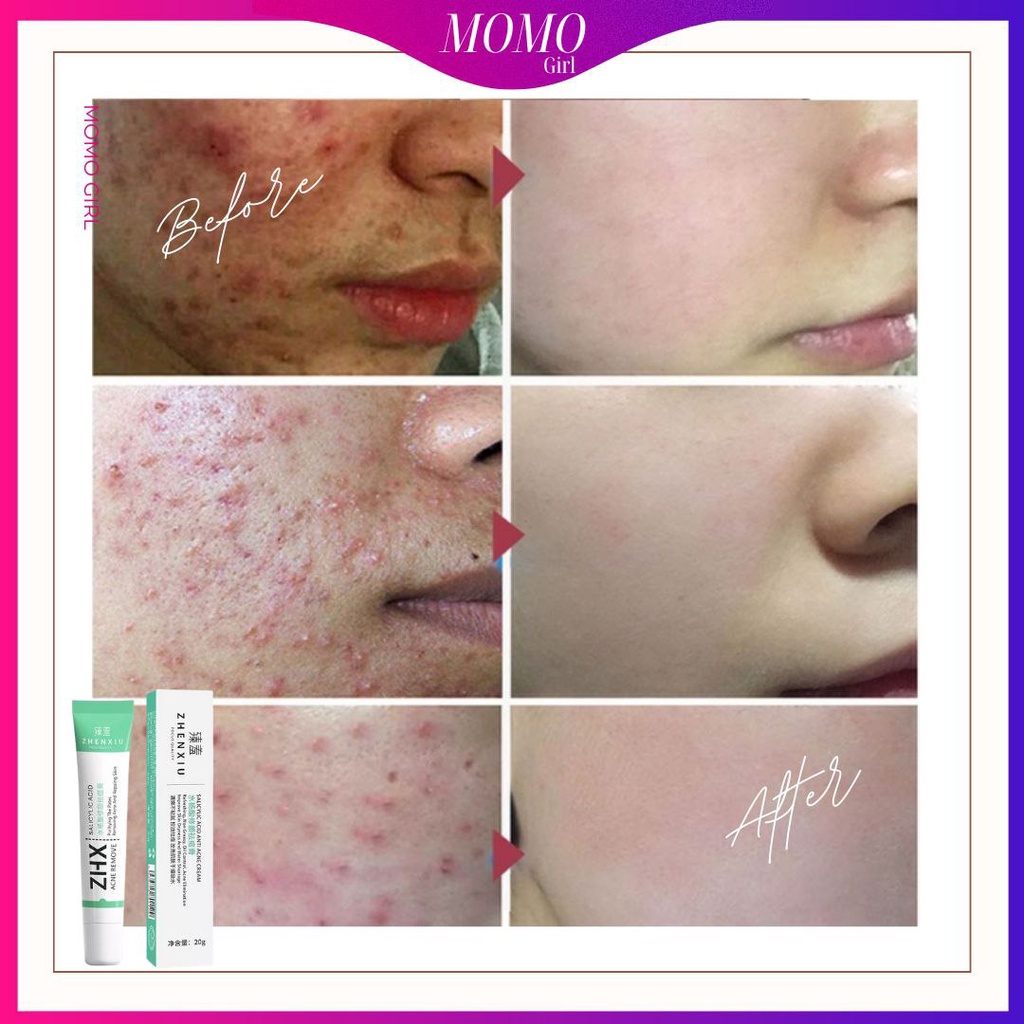 Anti Acne Cream Salicylic Acid ZHX Cystic Acne Treatment Acne Scar ...