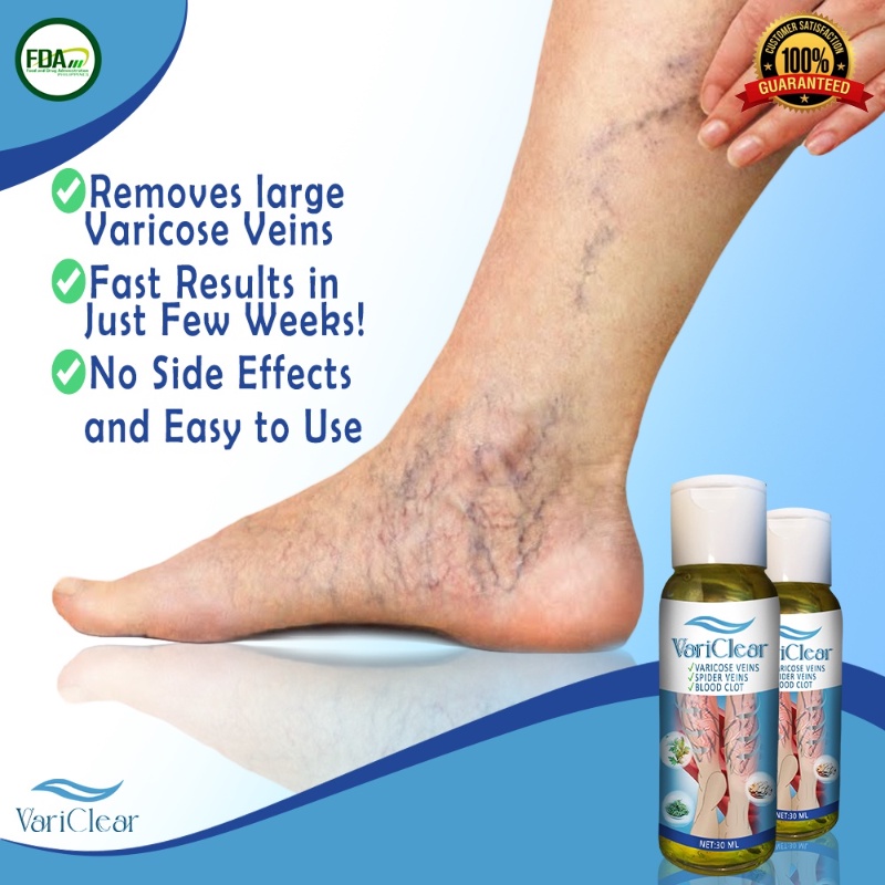 VariClear - VARICOSE VEINS, SPIDER VEINS, BLOOD CLOT | Shopee Malaysia