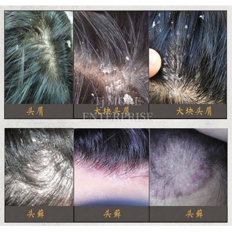 Dandruff Shampoo Gatal Herbal Tinea Capitis Bacteriostatic Oily Dry ...