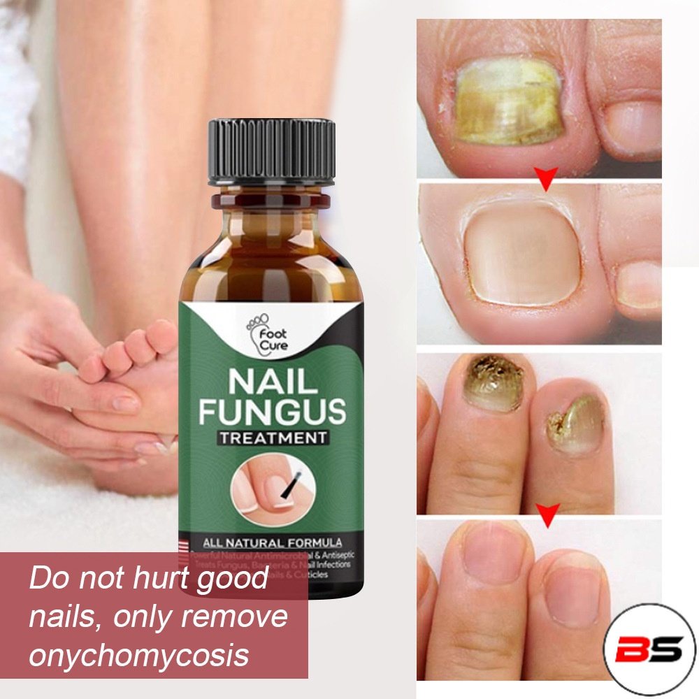 BS EXTRA STRONG Nail Fungus Treatment, Best Nail Repair, Stop Fungal Growth, Effective ...