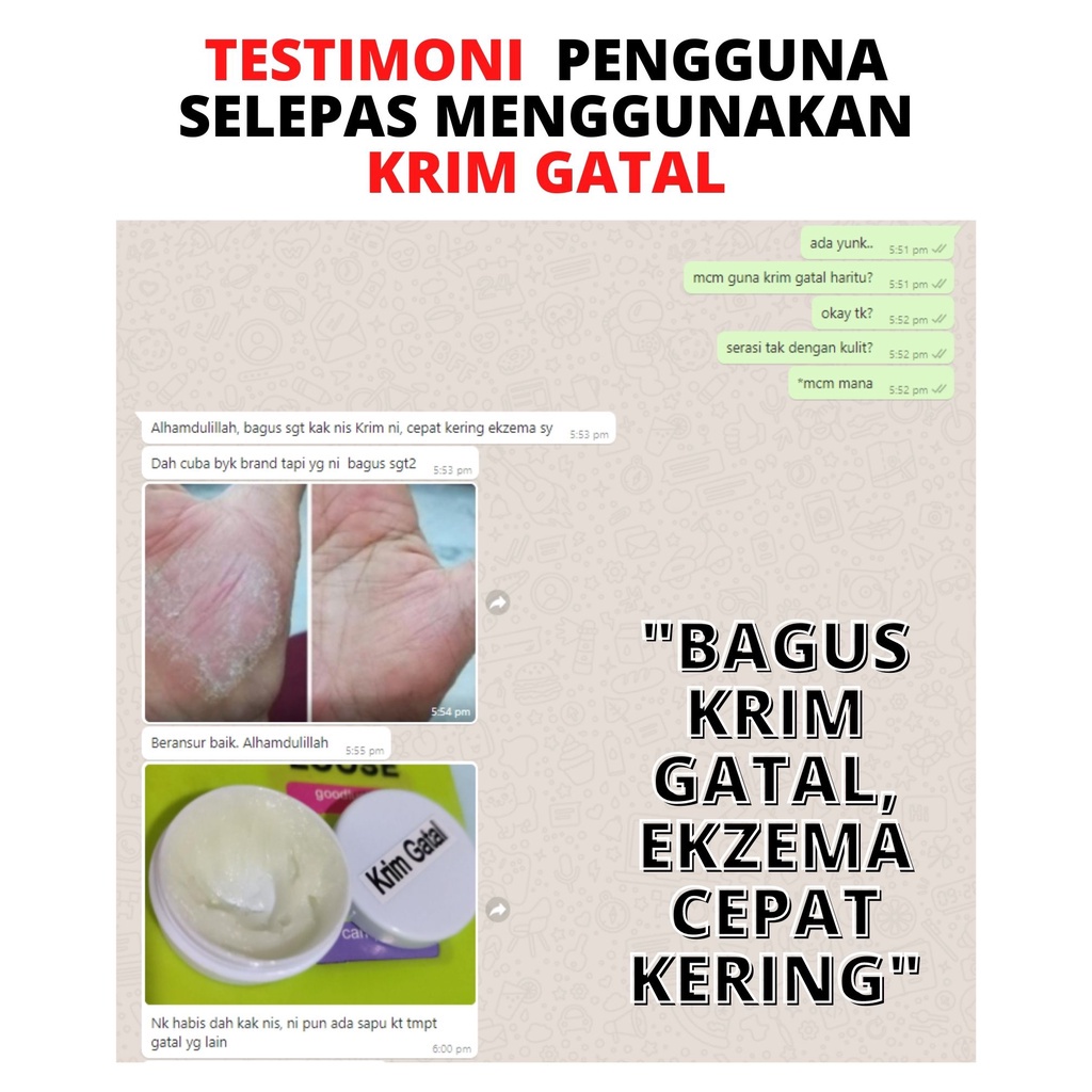 Eczema Cream Krim Gatal Kulit Ubat Panau Ubat Kurap Ubat Gatal ...