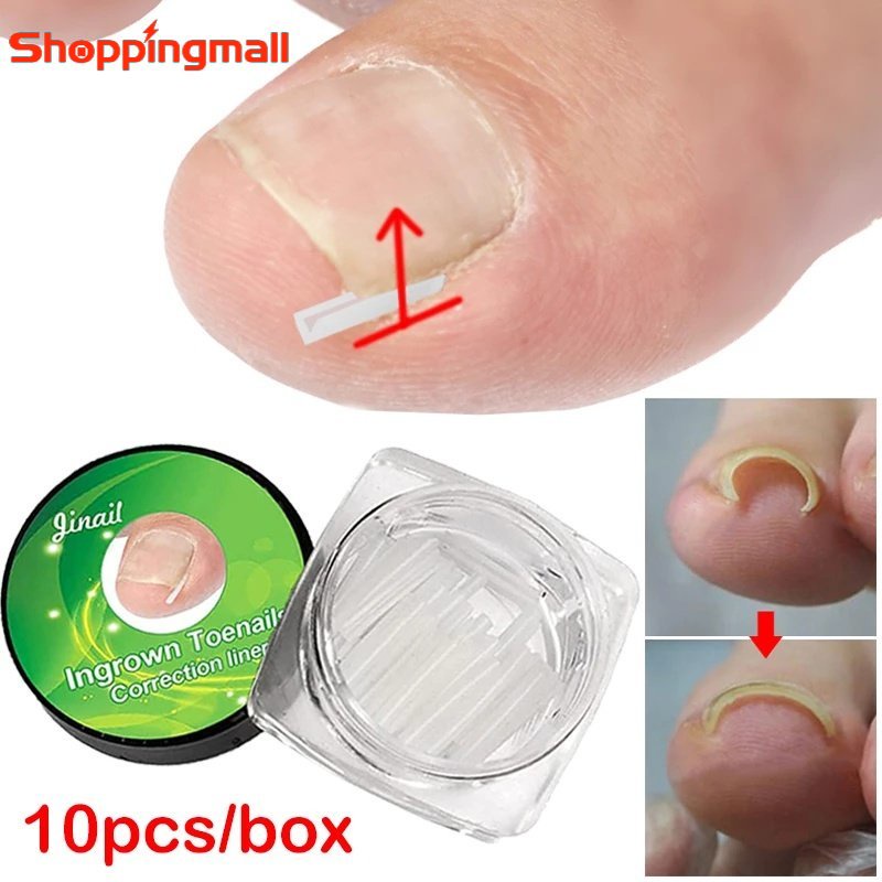 [Sunshine] 10Pcs Professional Ingrown Toenail Correction Tool / Ingrown ...