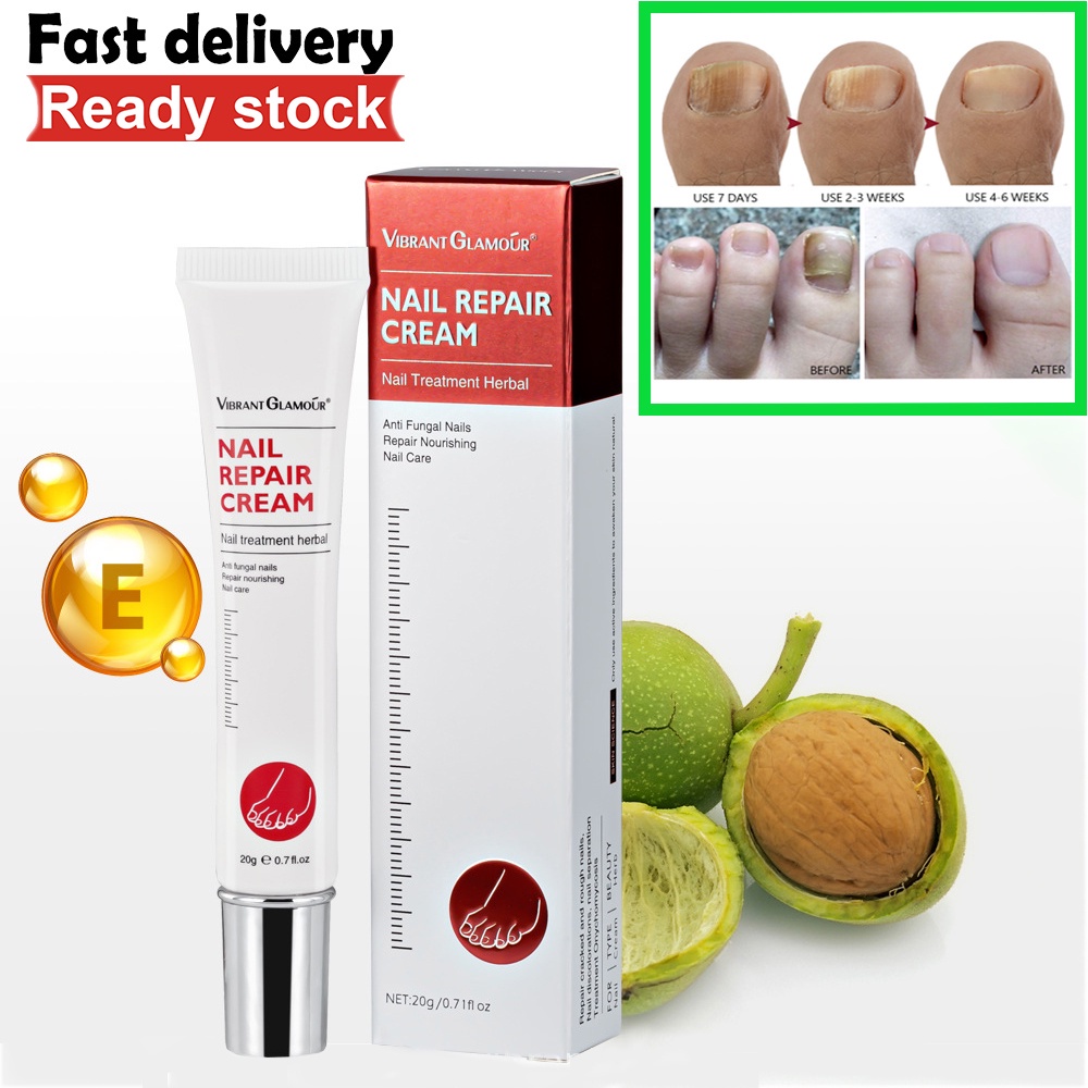 现货 Nail Repair Cream Anti Fungus Softens Cuticle Fungus Moisture ...