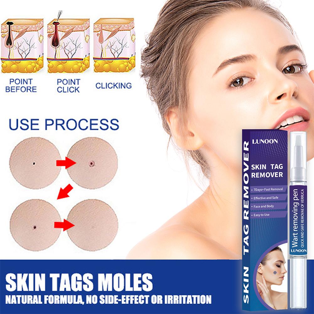 3ml Warts Removal Mole Remedy Liquid Skin Tag Remover Pen C7X1 | Shopee ...
