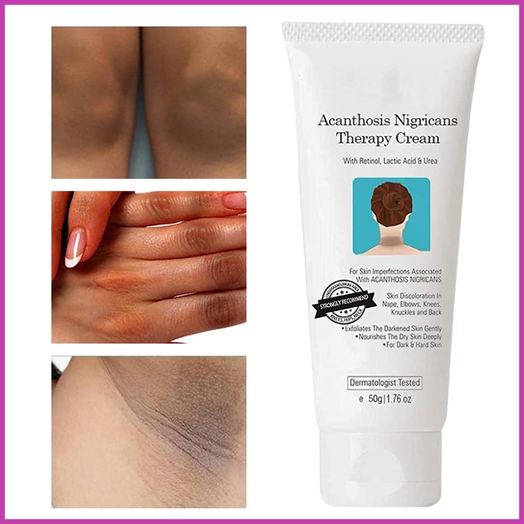 Acanthosis Cream Black Spot Cream for Body Acanthosis Moisturizing ...