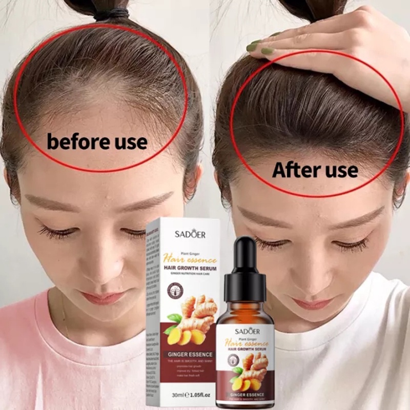 SADOER Hair Growth Fluid Ginger Fast Hair Growth Serum Repair Damaged Hair Conditioner Care Anti ...