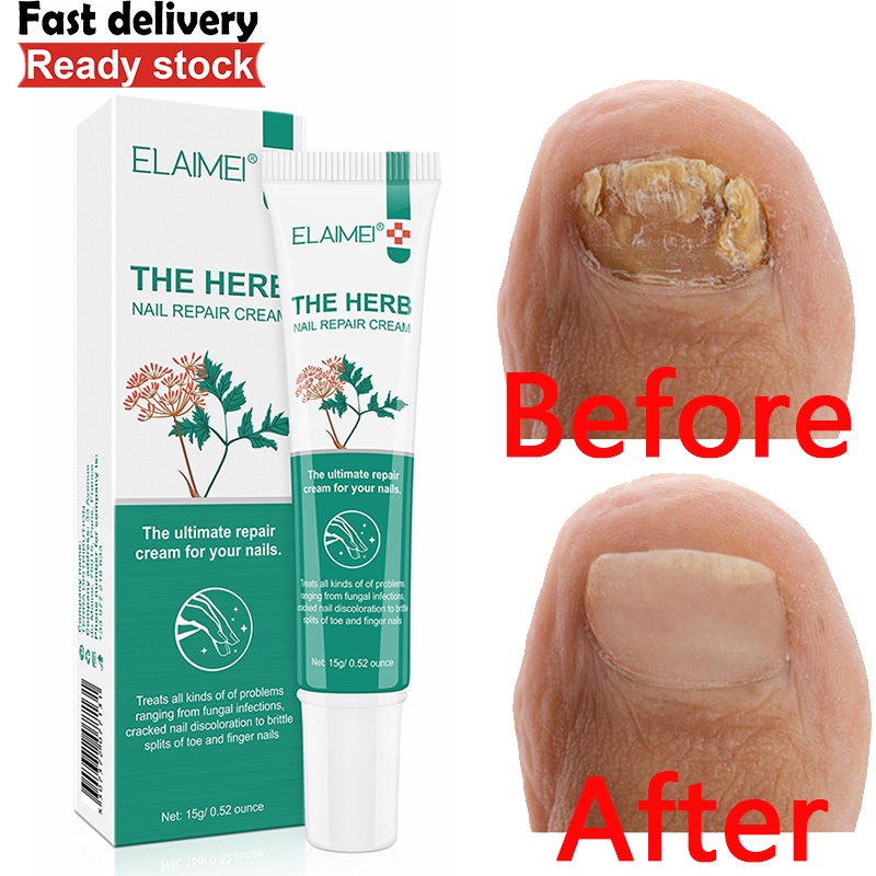 15g Nail Repair Cream Ointment For Nail Fungus Treatment Fingernail ...