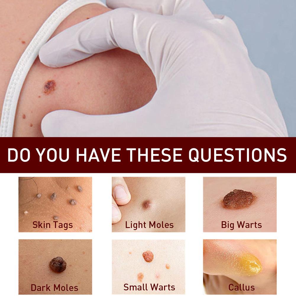 3ml Wart Treatment Removing Nevi Wart Treatment Pen Skin Care | Shopee ...