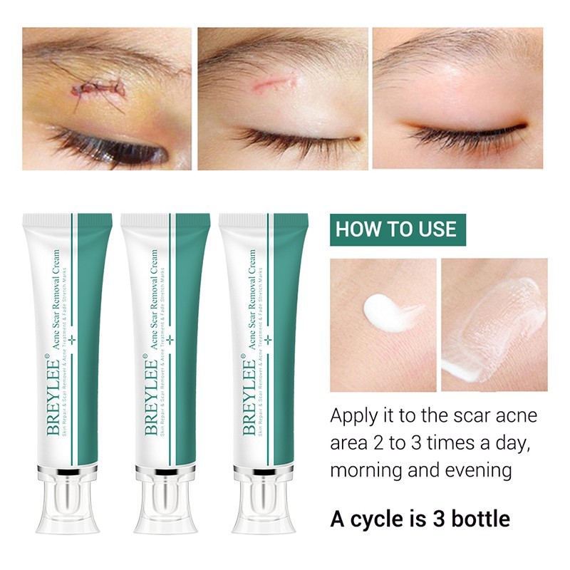 BREYLEE Acne Scar Removal Cream Skin Repair Scar Remover Acne Treatment Fade Stretch Marks Skin ...