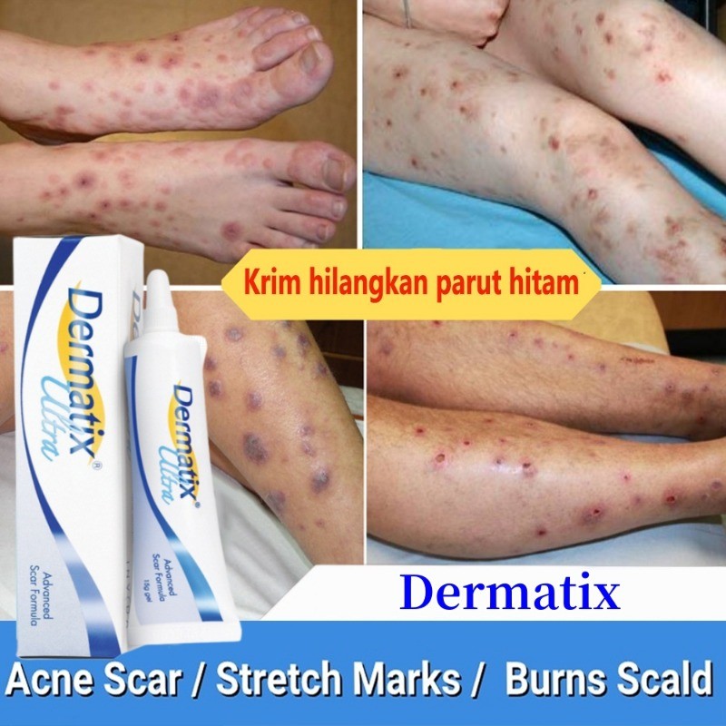 15g Dermatix Ultra Scar Gel Scar Removal Cream | Shopee Malaysia