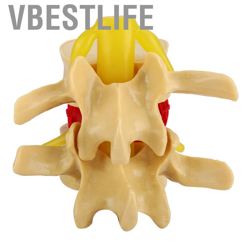 VBESTLIFE Human Lumbar Vertebrae Degenerative PVC Disc Herniation Model ...