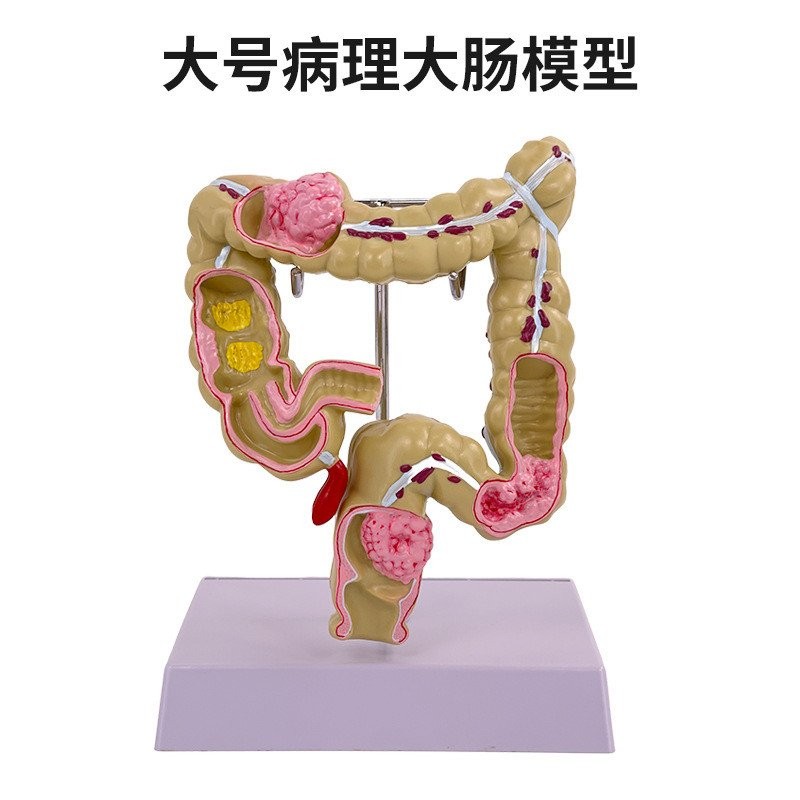 Simulasi Pengajaran Model Patologi Kolon Usus Besar Lesi Rektum ...