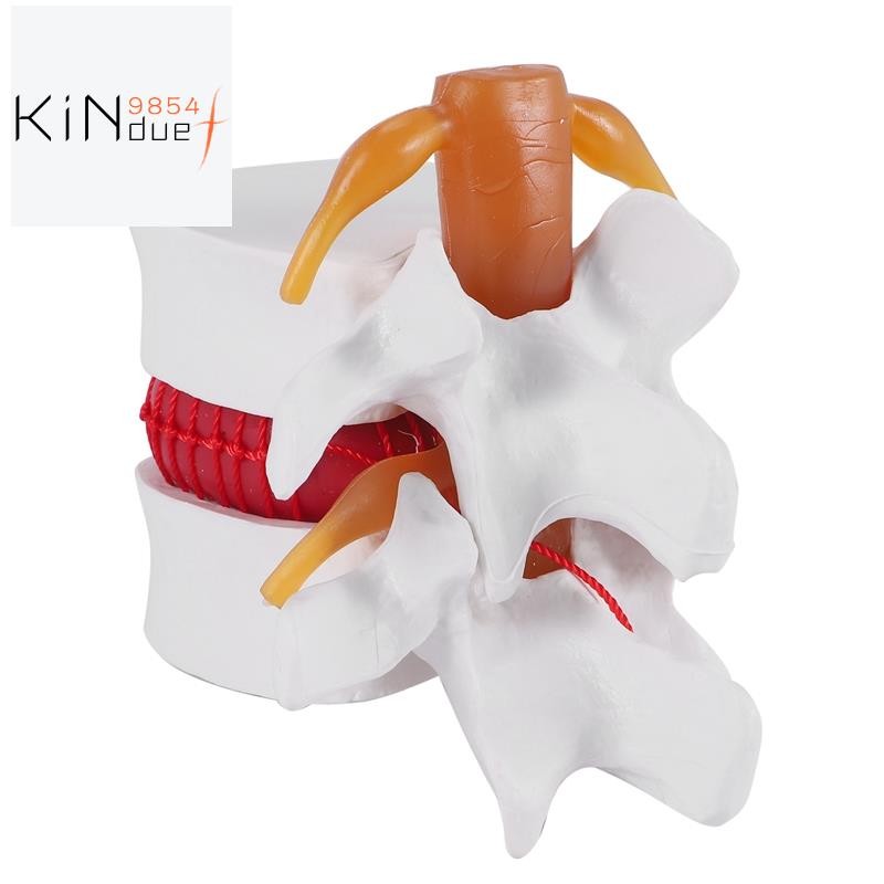 1:1.5 Human Lumbar Disc Herniation Demonstration Model of Lumbar ...