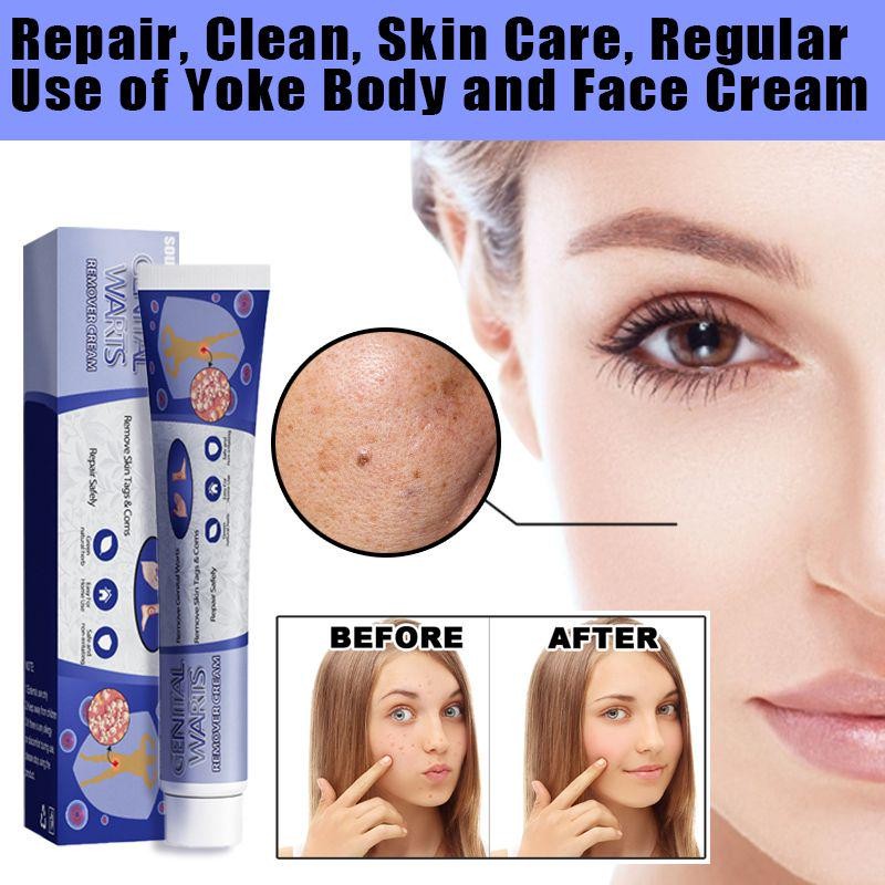 Warts Removal Cream, Skin Tag Remover, Cholesterol Seed Mole Warts ...