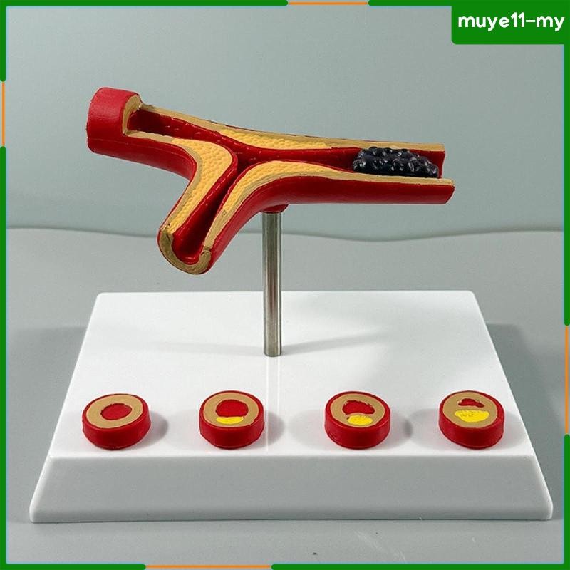 [MuyeadMY] Human Vessel Model Human Atherosclerosis Lightweight Science ...